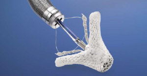 経皮的僧帽弁接合不全修復術「MitraClip（マイトラクリップ）」を紹介 | CEじゃーなる