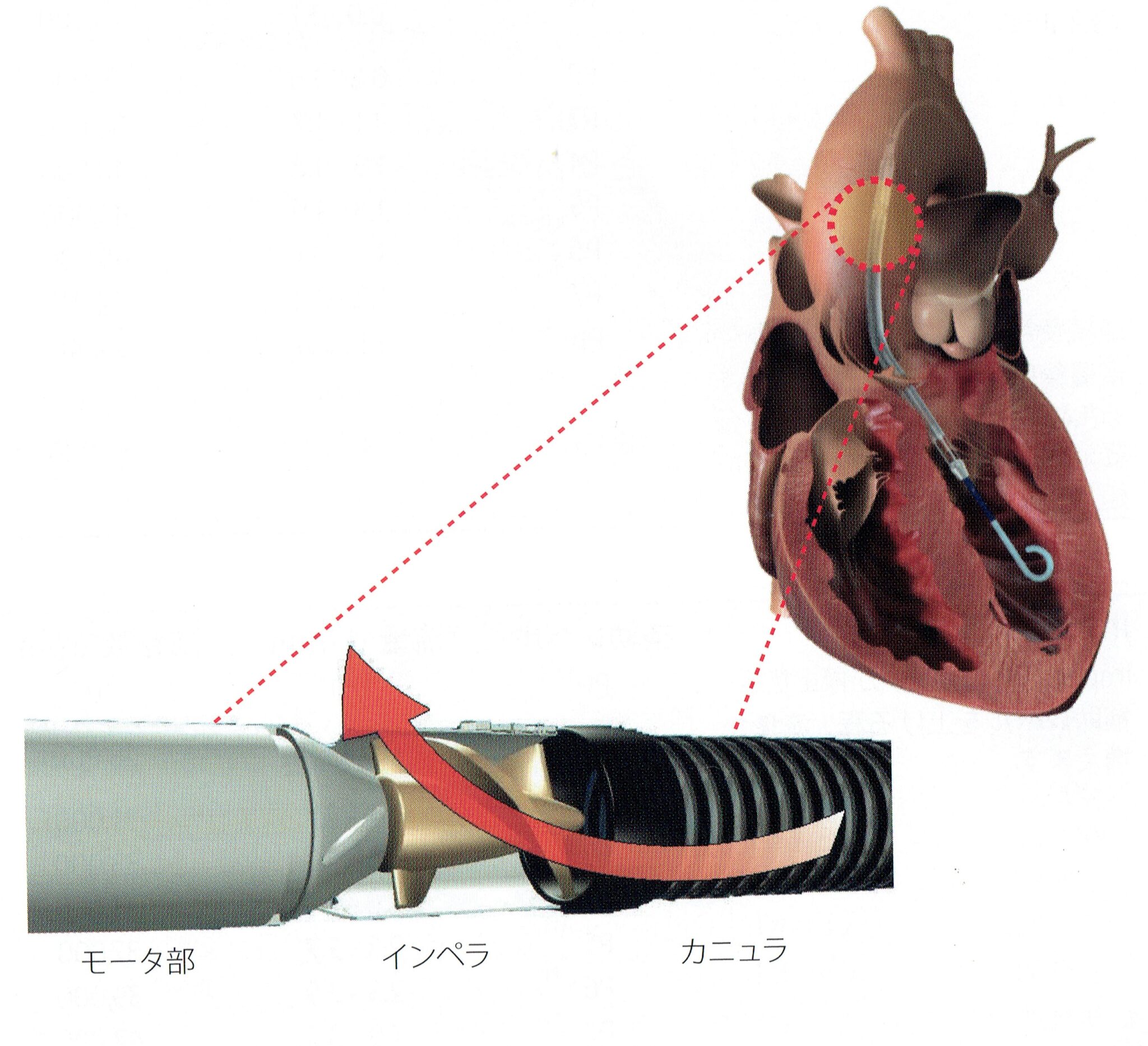 IMPELLA（インペラ）とは ー新たな補助循環デバイスー | CEじゃーなる