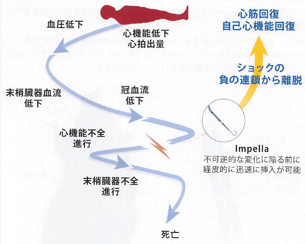 補助循環 IMPELLA― 治療目標と効果 ― | CEじゃーなる