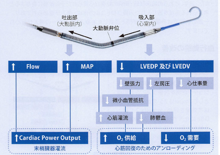 補助循環 IMPELLA― 治療目標と効果 ― | CEじゃーなる