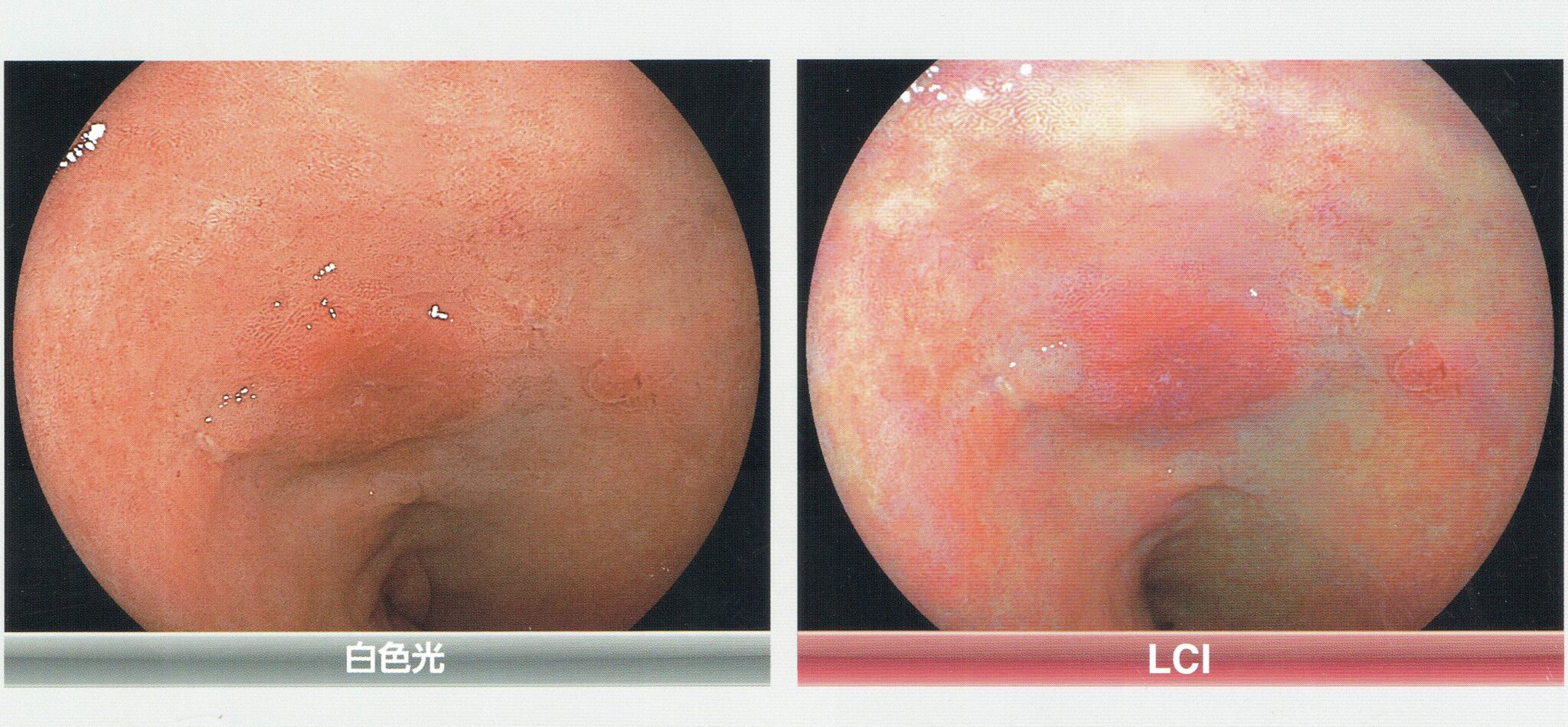 内視鏡の特殊光観察（IEE）について FUJIFILM編 | CEじゃーなる