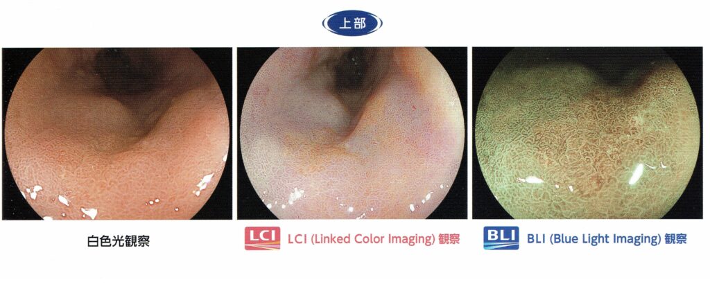 内視鏡の特殊光観察（IEE）について FUJIFILM編 | CEじゃーなる