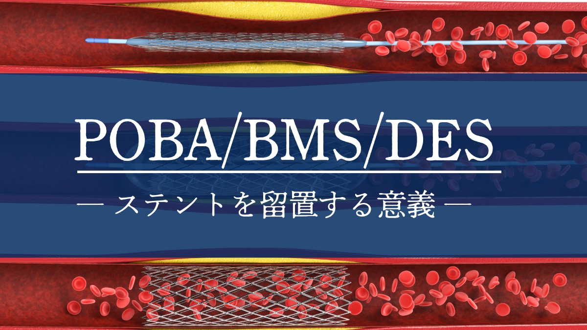 POBA/BMS/DESについて— ステントを留置する意義 — | CEじゃーなる