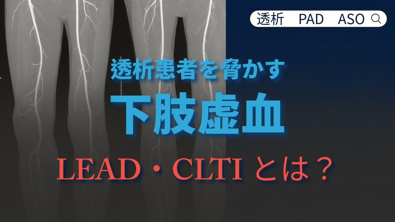 【PAD】透析患者を脅かす下肢虚血—LEAD・CLTIとは？— | CEじゃーなる
