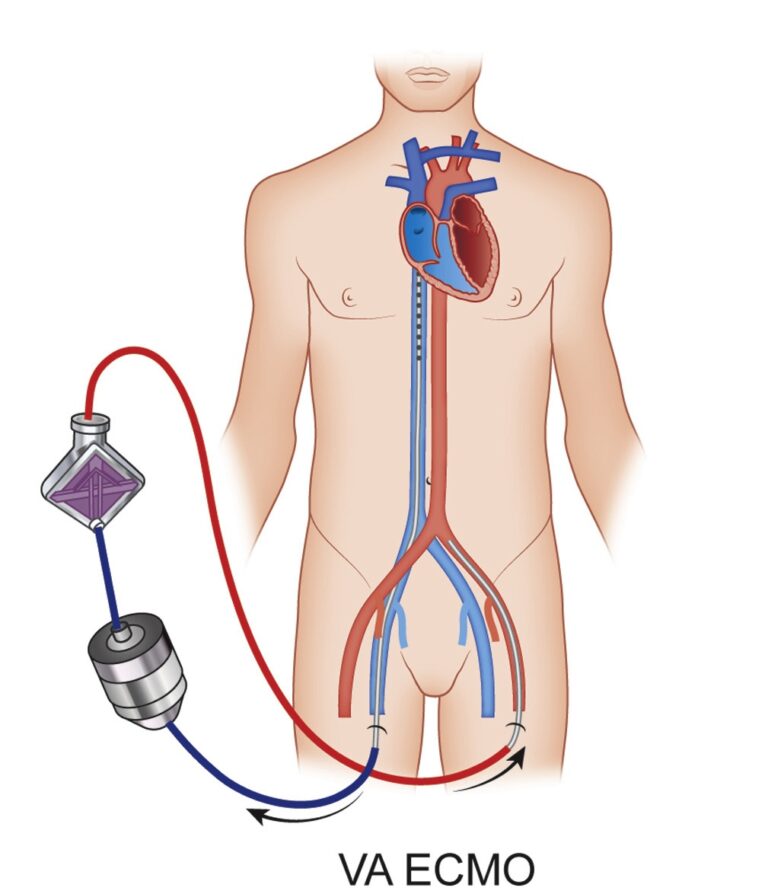 V-A ECMO の概要と導入基準 —Cardiac ECMOとは— | CEじゃーなる